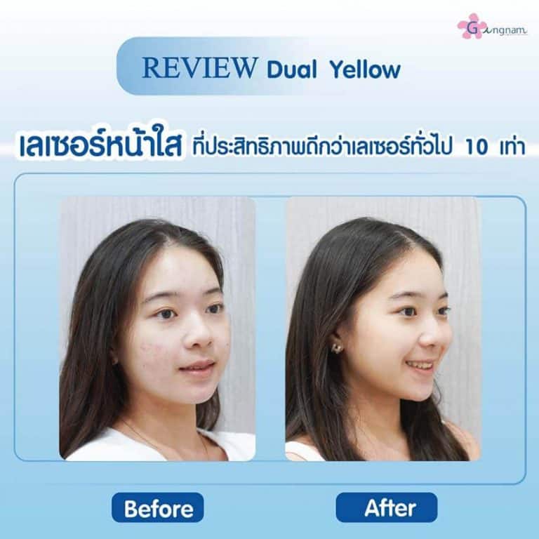 เจาะลึก Dual Yellow Laser คืออะไร เหมาะกับใคร เทียบกับเครื่องตัวอื่นๆ ...