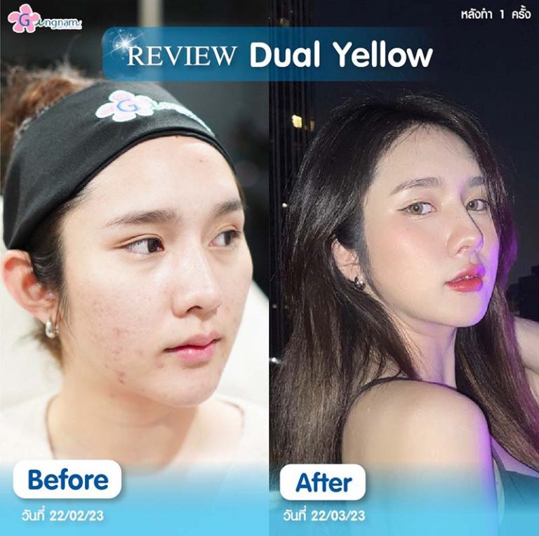 เจาะลึก Dual Yellow Laser คืออะไร เหมาะกับใคร เทียบกับเครื่องตัวอื่นๆ ...