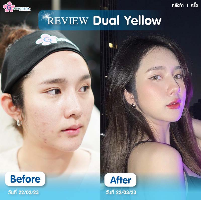 เจาะลึก Dual Yellow Laser คืออะไร เหมาะกับใคร เทียบกับเครื่องตัวอื่นๆ ...