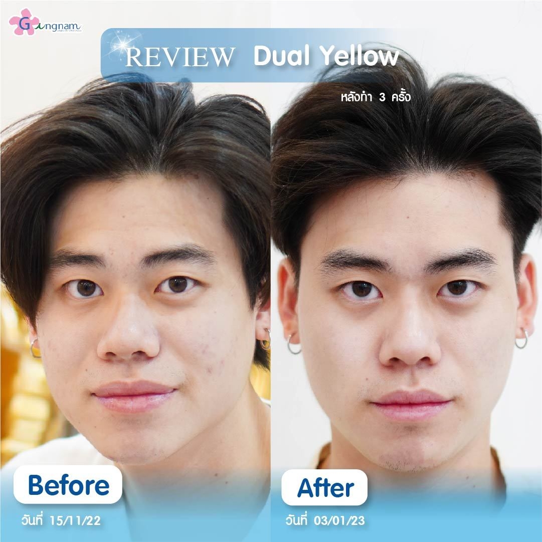 เจาะลึก Dual Yellow Laser คืออะไร เหมาะกับใคร เทียบกับเครื่องตัวอื่นๆ ...