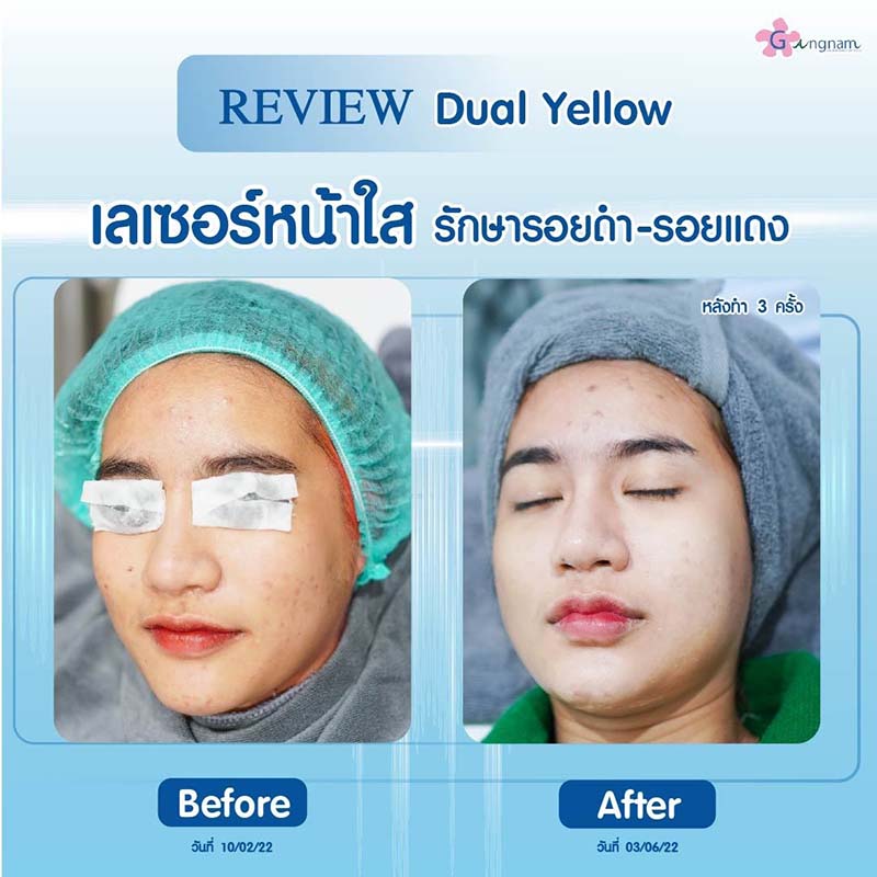 เจาะลึก Dual Yellow Laser คืออะไร เหมาะกับใคร เทียบกับเครื่องตัวอื่นๆ ...