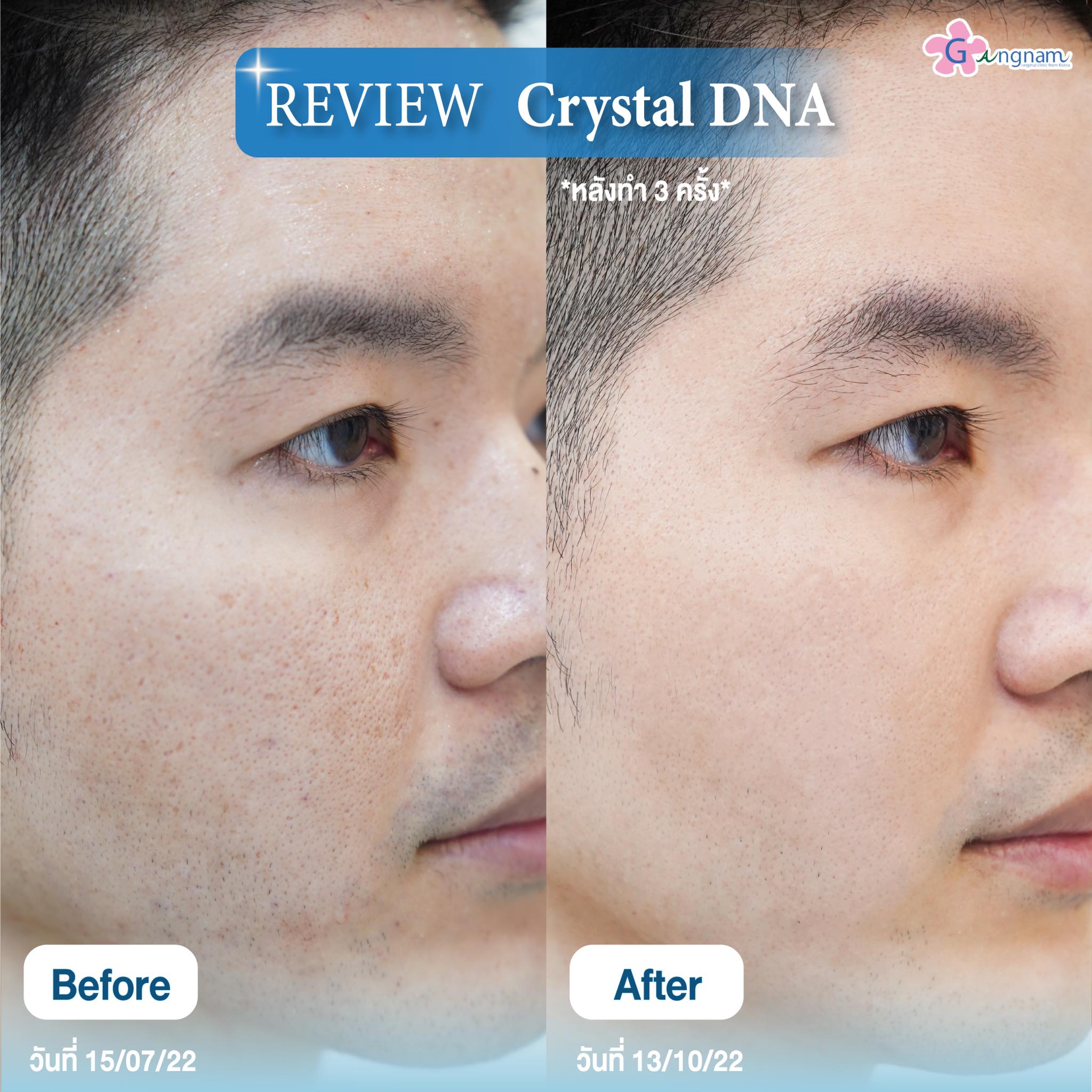 Crystal DNA คืออะไร? ช่วยฟื้นฟูผิวเรื่องอะไร ใครบ้างควรทำ? - Gangnam Clinic