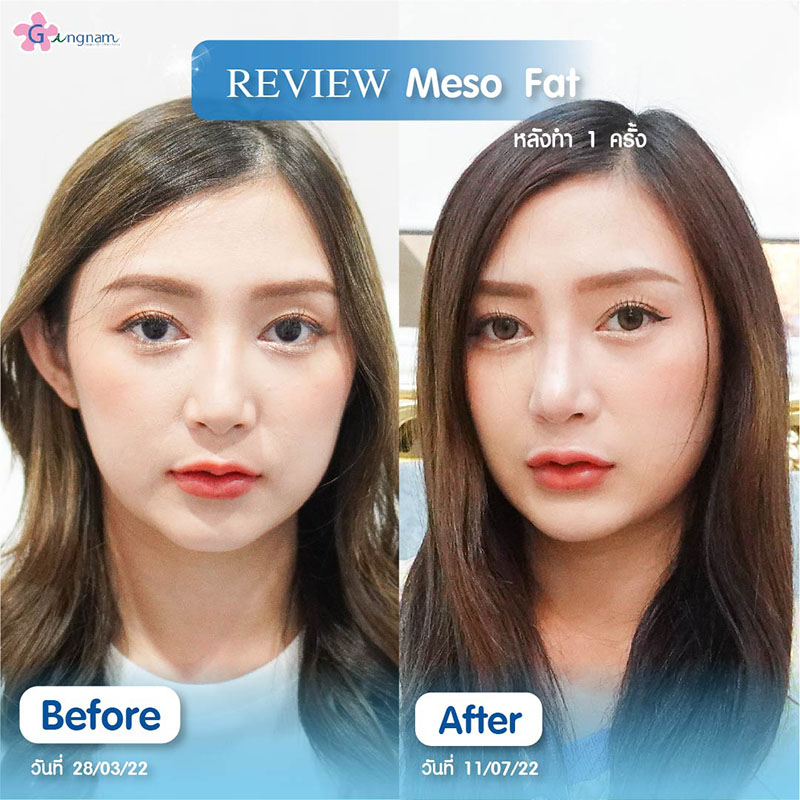 Meso Fat Filorga รีวิว Online | www.simpleplanning.net