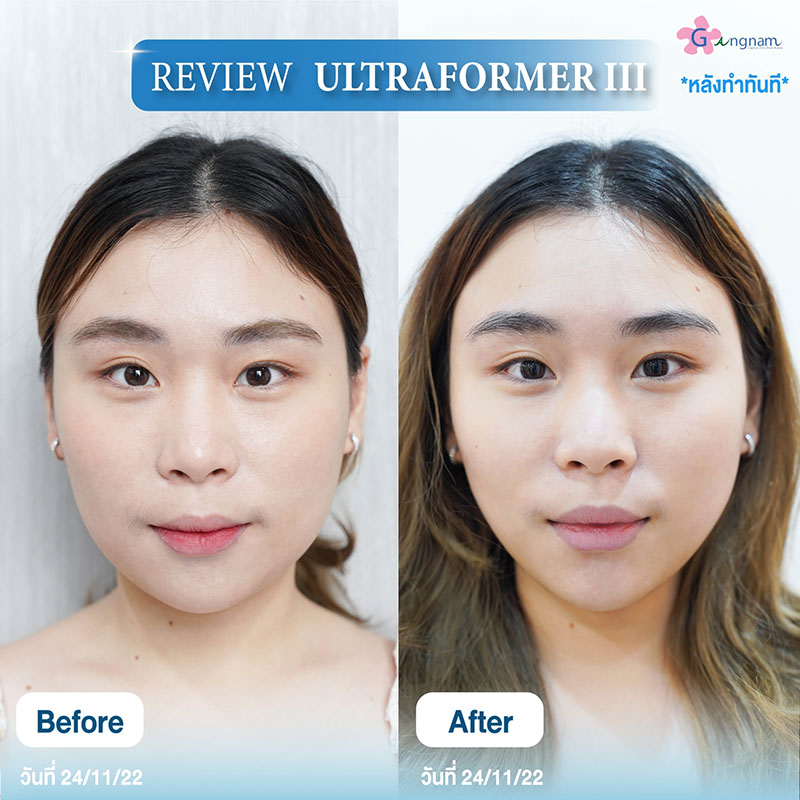 Ultraformer MPT ยกกระชับหน้า ปรับรูปร่าง ให้ผิวกระชับเต่งตึงขึ้น ...