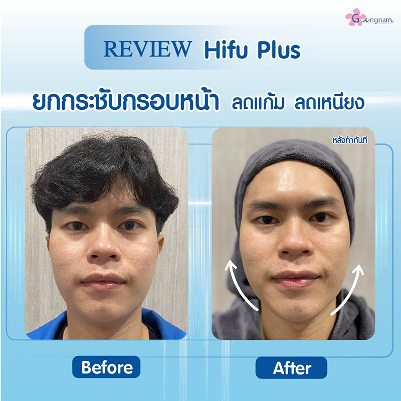 10 ข้อควรรู้ก่อนทำ Hifu คืออะไร? มีกี่แบบ? เลือกยี่ห้อไหนดี ให้เหมาะกับ ...