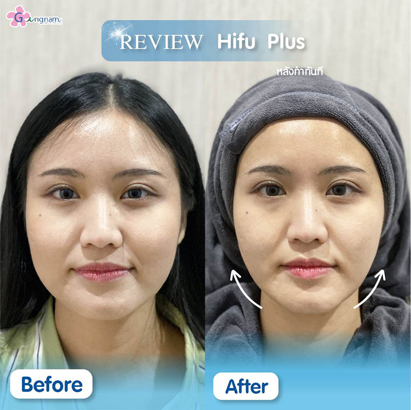 10 ข้อควรรู้ก่อนทำ Hifu คืออะไร? มีกี่แบบ? เลือกยี่ห้อไหนดี ให้เหมาะกับ ...