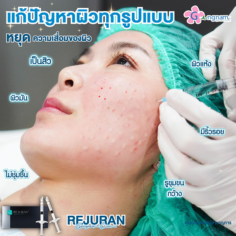 Rejuran คืออะไร? ข้อดี ข้อเสีย ต่างจากเมโสตัวอื่นอย่างไร อยู่ได้นานแค่ไหน