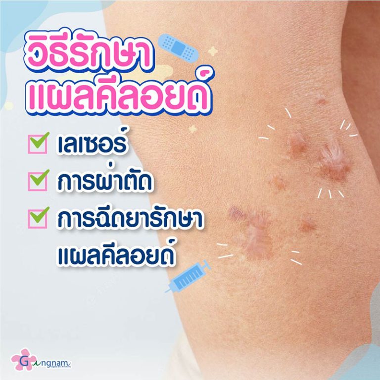 แผลเป็นคีลอยด์ (Keloid) คือ? เกิดจากอะไร? พร้อมรู้วิธีรักษาให้รอยนูนยุบลง