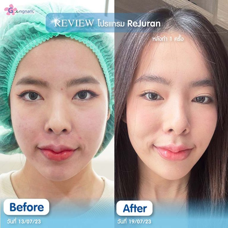 Rejuran คืออะไร? ข้อดี ข้อเสีย ต่างจากเมโสตัวอื่นอย่างไร อยู่ได้นานแค่ไหน