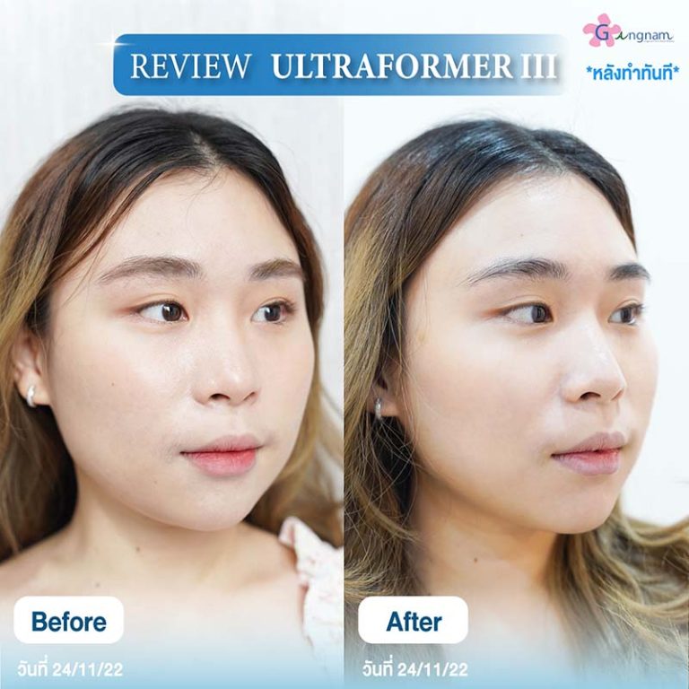Ultraformer III คืออะไร? ช่วยเรื่องอะไรบ้าง ทำแล้วเห็นผลจริงไหม? - Gangnam Clinic
