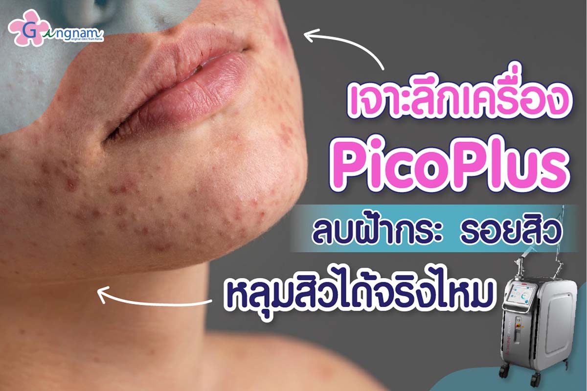 PicoPlus laser คืออะไร ช่วยแก้ปัญหาเรื่องผิวแบบไหน เหมาะกับใครบ้าง ดี ...