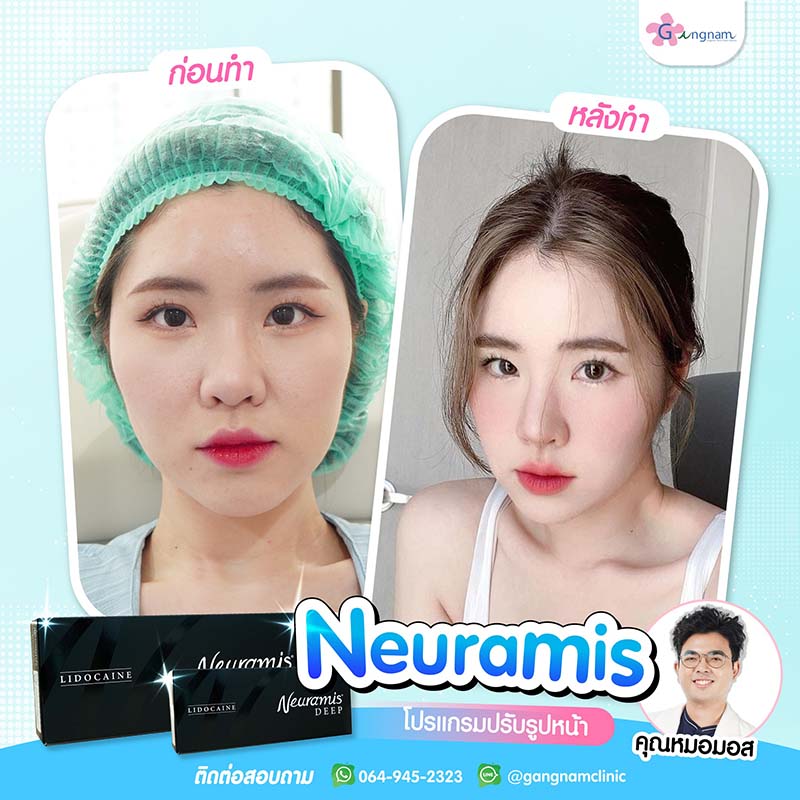 รู้จัก ฟิลเลอร์ Neuramis ดีไหม? มีกี่แบบ เหมาะกับฉีดตำแหน่งไหน ...
