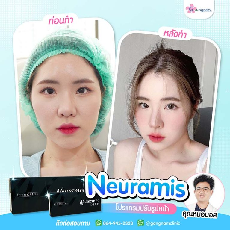 รู้จัก ฟิลเลอร์ Neuramis ดีไหม? มีกี่แบบ เหมาะกับฉีดตำแหน่งไหน? - Gangnam Clinic