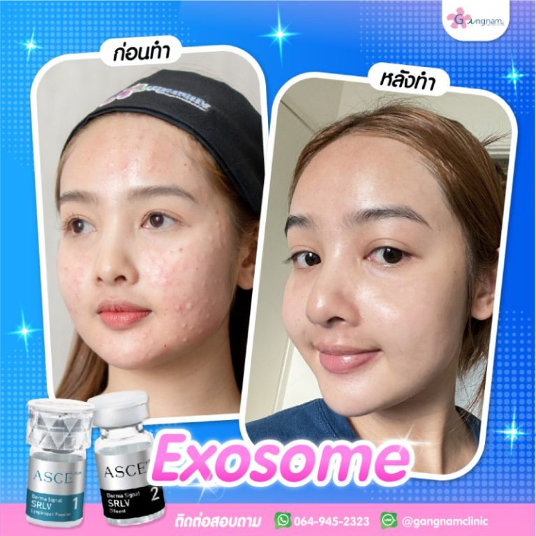 เทรนด์ฉีดผิวหน้าด้วย Exosome คืออะไร? ช่วยเรื่องอะไรบ้าง ดีจริงไหม?