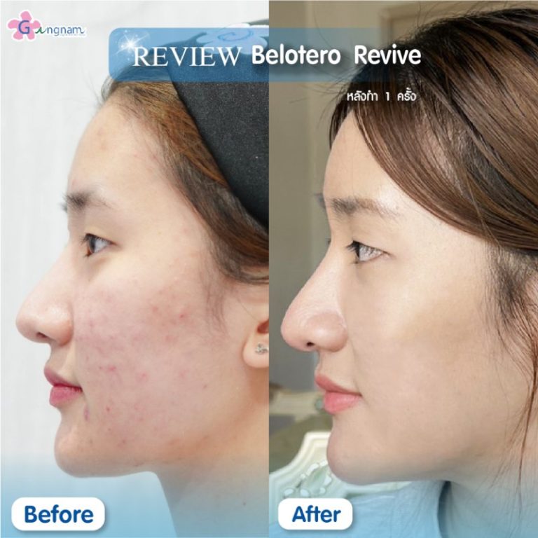 รู้จัก ฟิลเลอร์ Belotero Revive ช่วยแก้ปัญหาเรื่องผิวแบบไหน เหมาะกับใคร ...