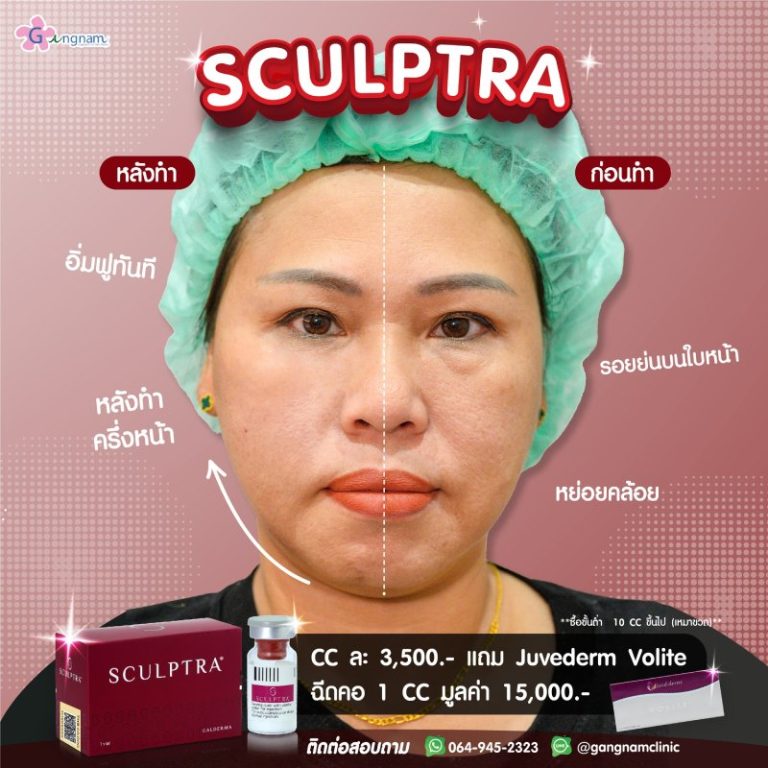 Sculptra คืออะไร? เหมาะกับใคร ช่วยเรื่องอะไรบ้าง ฉีดแล้วดีจริงไหม? - Gangnam Clinic