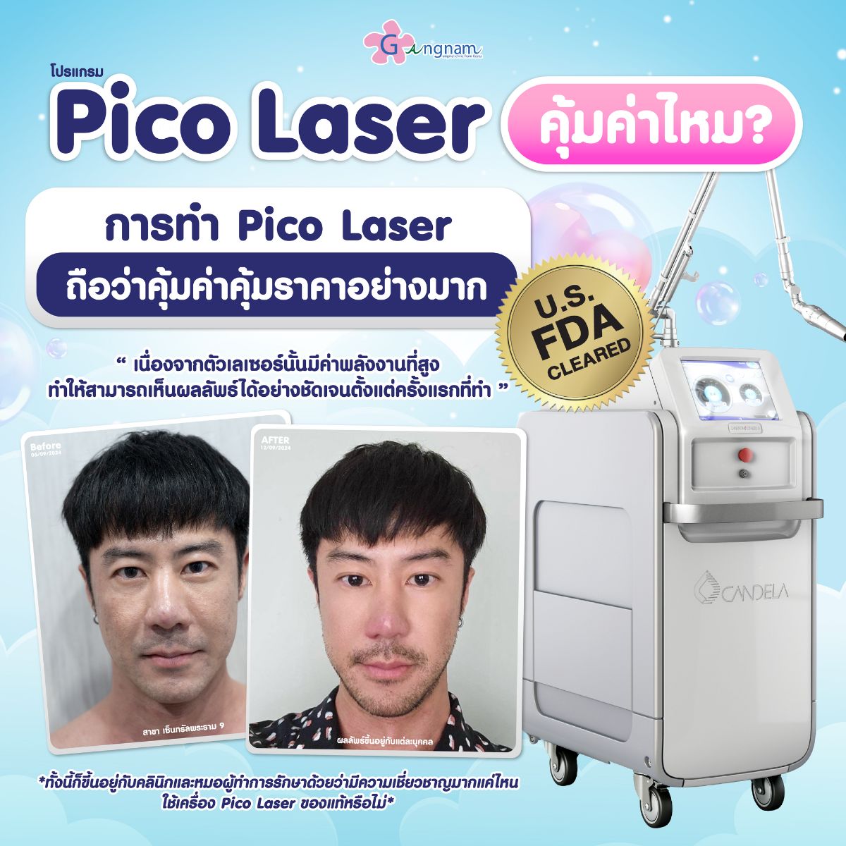 Pico Laser ราคาเท่าไหร่ ต้องทำกี่ครั้งถึงจะเห็นผล