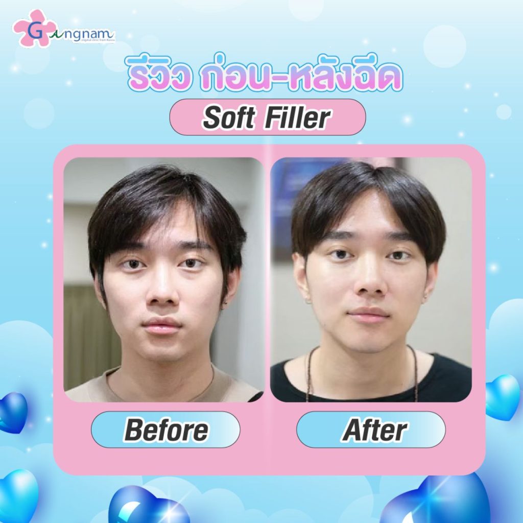 Soft Filler คืออะไร ดีจริงไหม อันตรายหรือไม่ คลายทุกข้อสงสัย